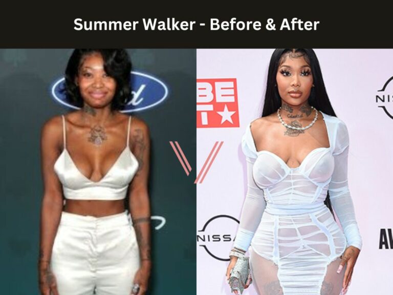 Celebrities With Bbl Before And After Photos