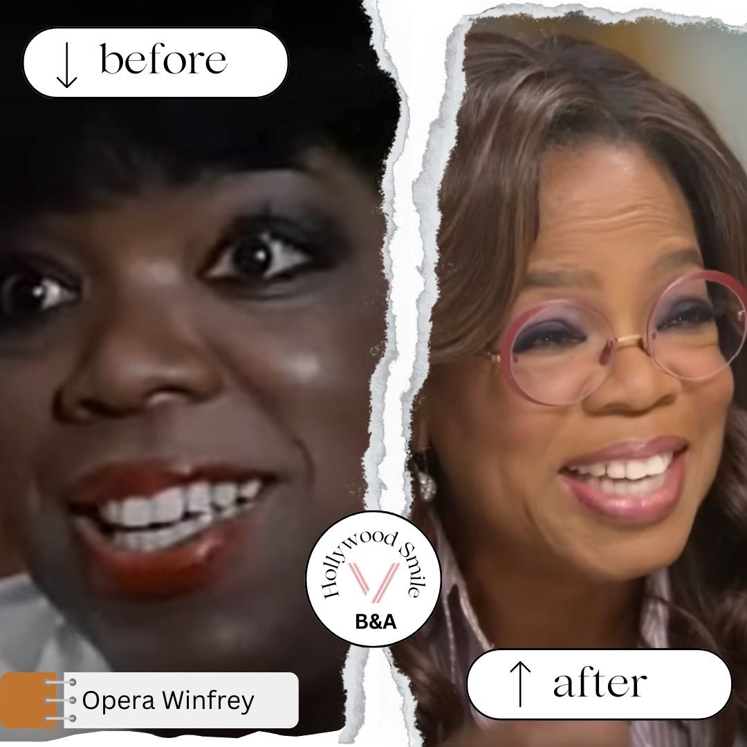 Celebrities Smile Makeovers (Hollywood Smile) Before and After