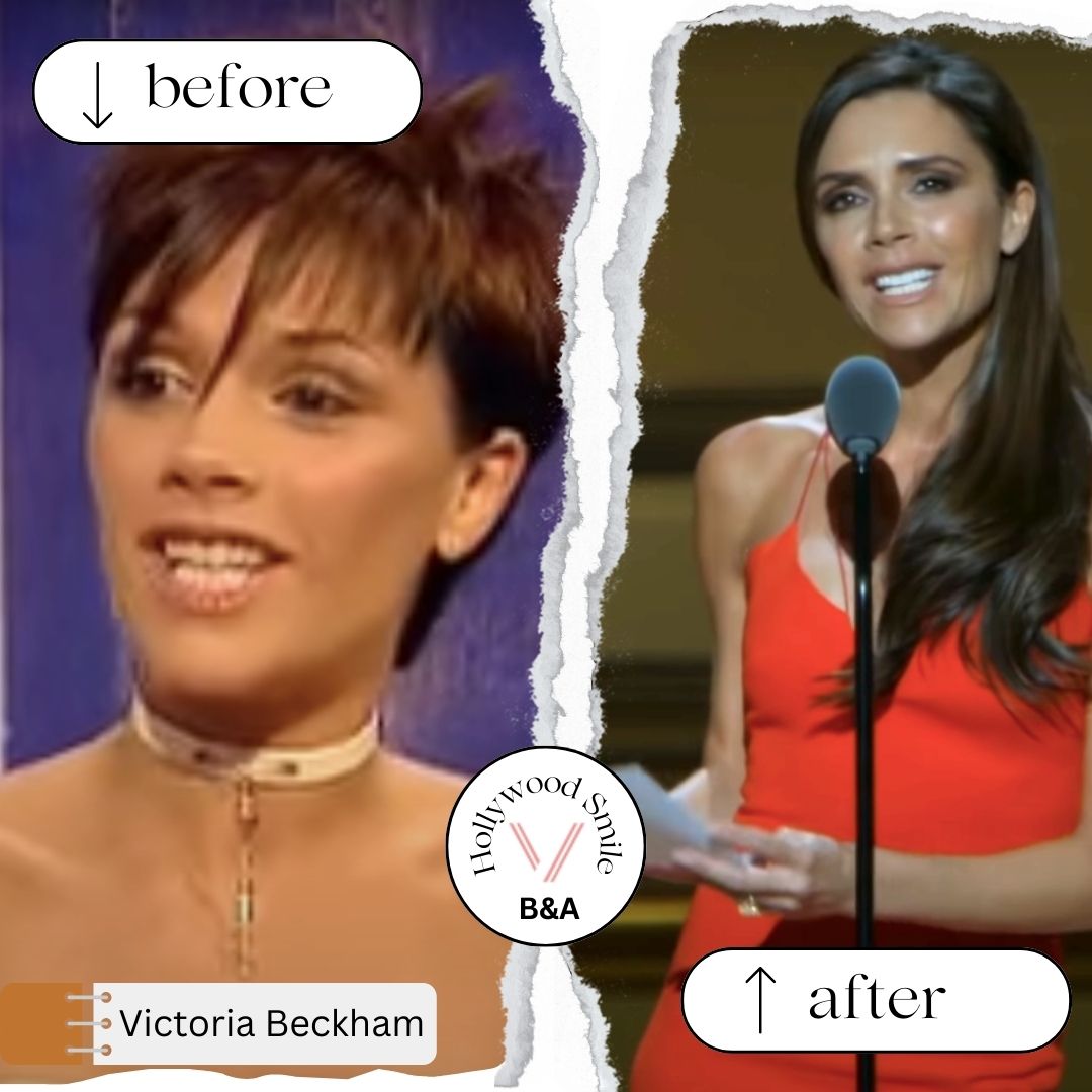 Celebrities Smile Makeovers Hollywood Smile Before And After