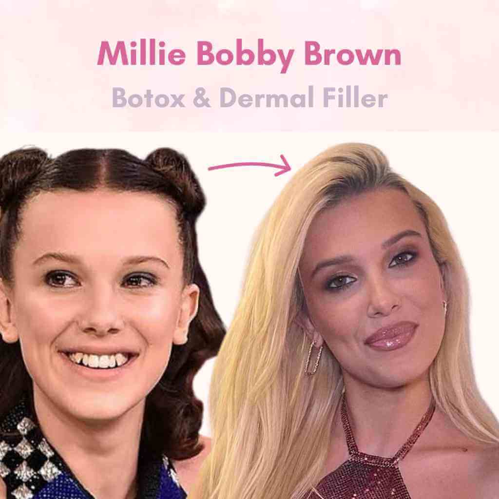 30 Celebrity Botox & Filler Favorites - Vantage Clinic - Cosmetic ...