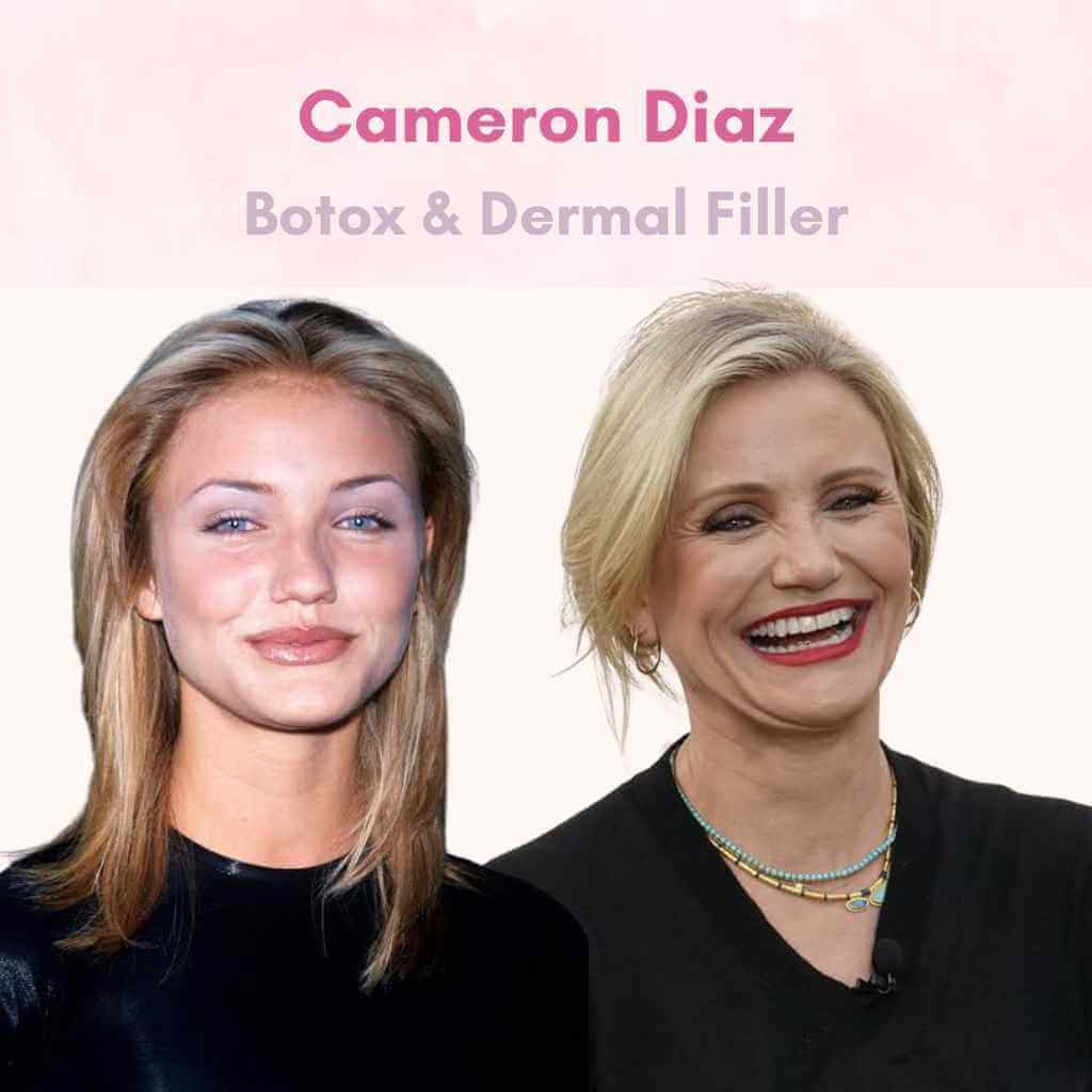 30 Celebrity Botox & Filler Favorites - Vantage Clinic - Cosmetic ...
