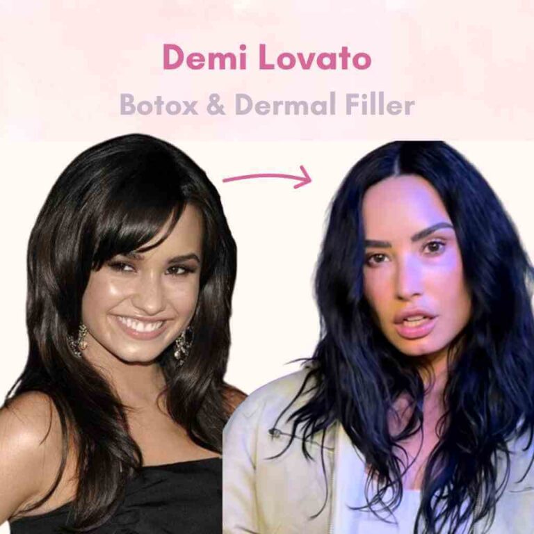 22 Celebrity Botox & Filler Favorites - Vantage Clinic - Cosmetic ...