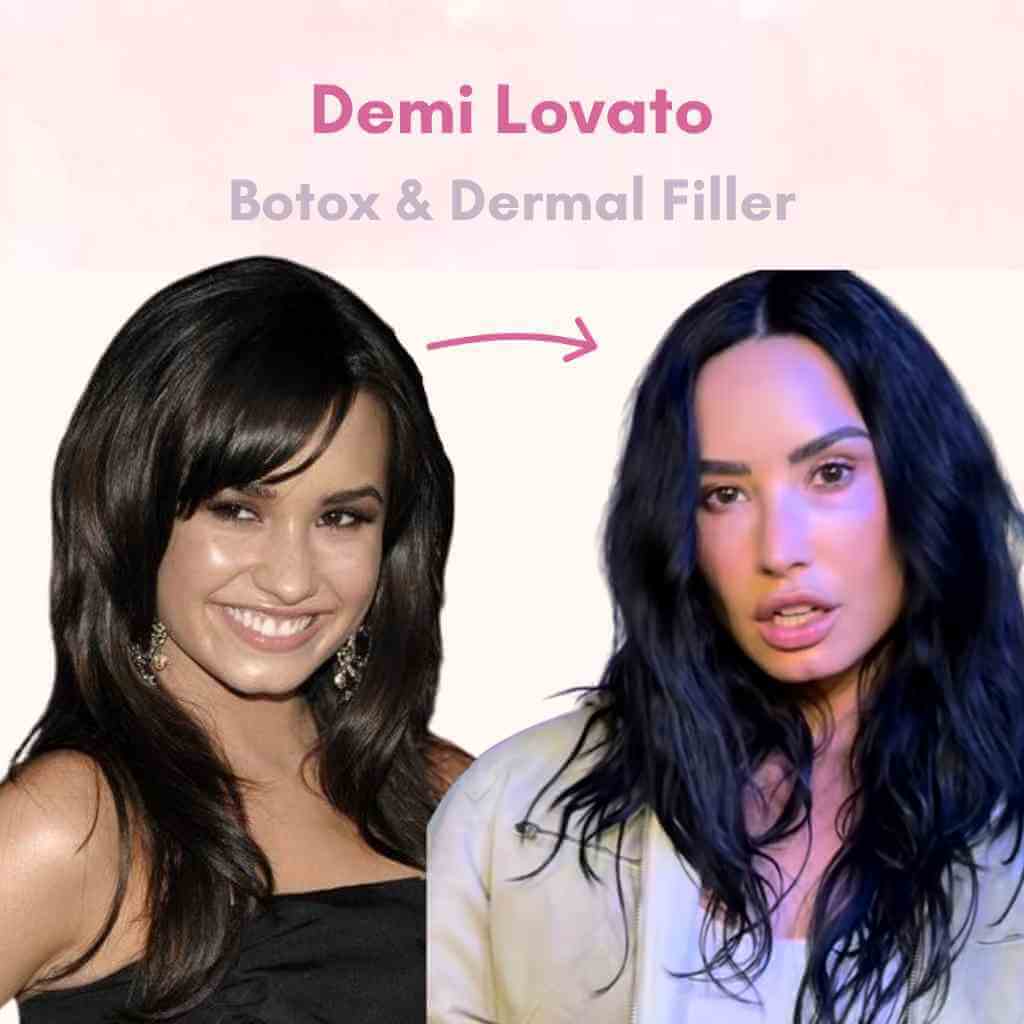 30 Celebrity Botox & Filler Favorites - Vantage Clinic - Cosmetic ...