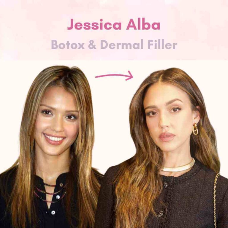 22 Celebrity Botox & Filler Favorites - Vantage Clinic - Cosmetic ...