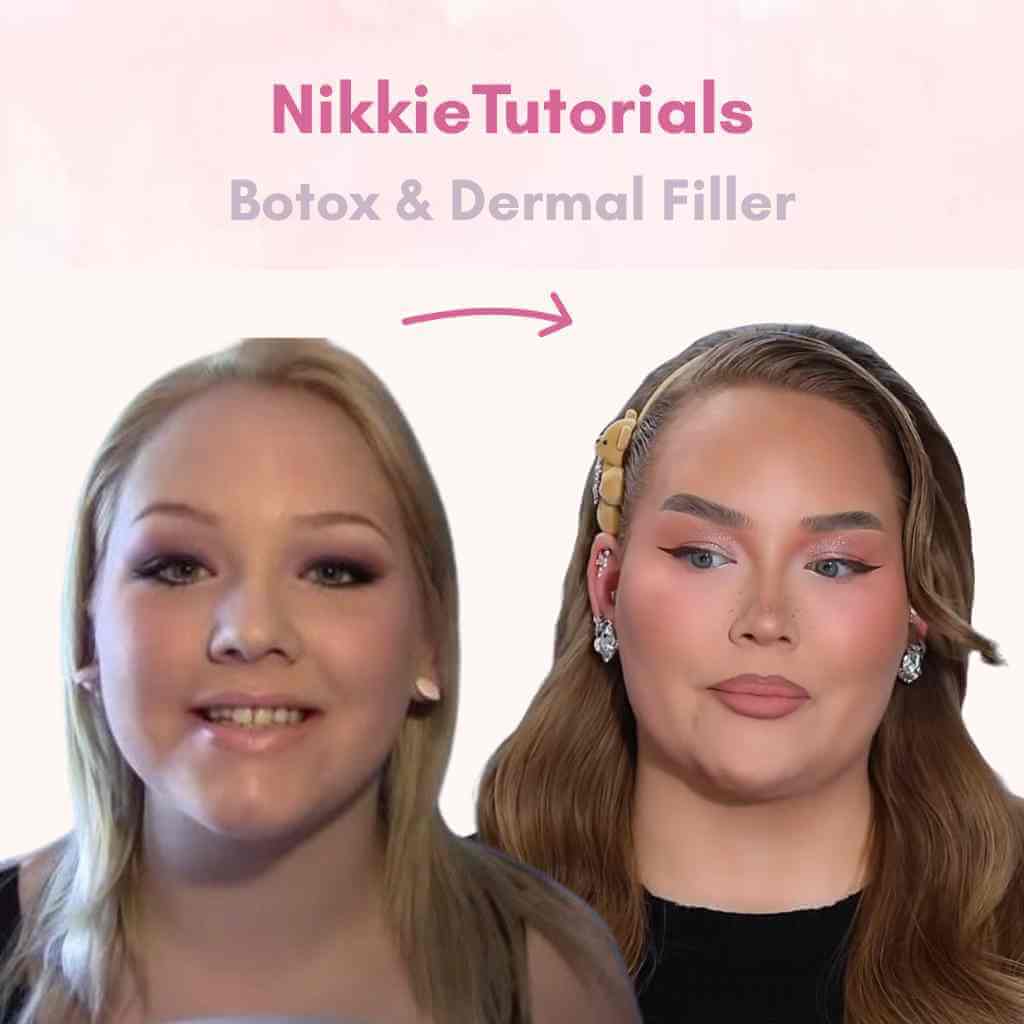 22 Celebrity Botox & Filler Favorites - Vantage Clinic - Cosmetic ...