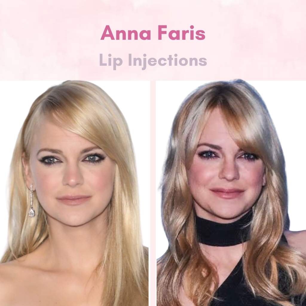 30 Celebrity Botox & Filler Favorites - Vantage Clinic - Cosmetic ...