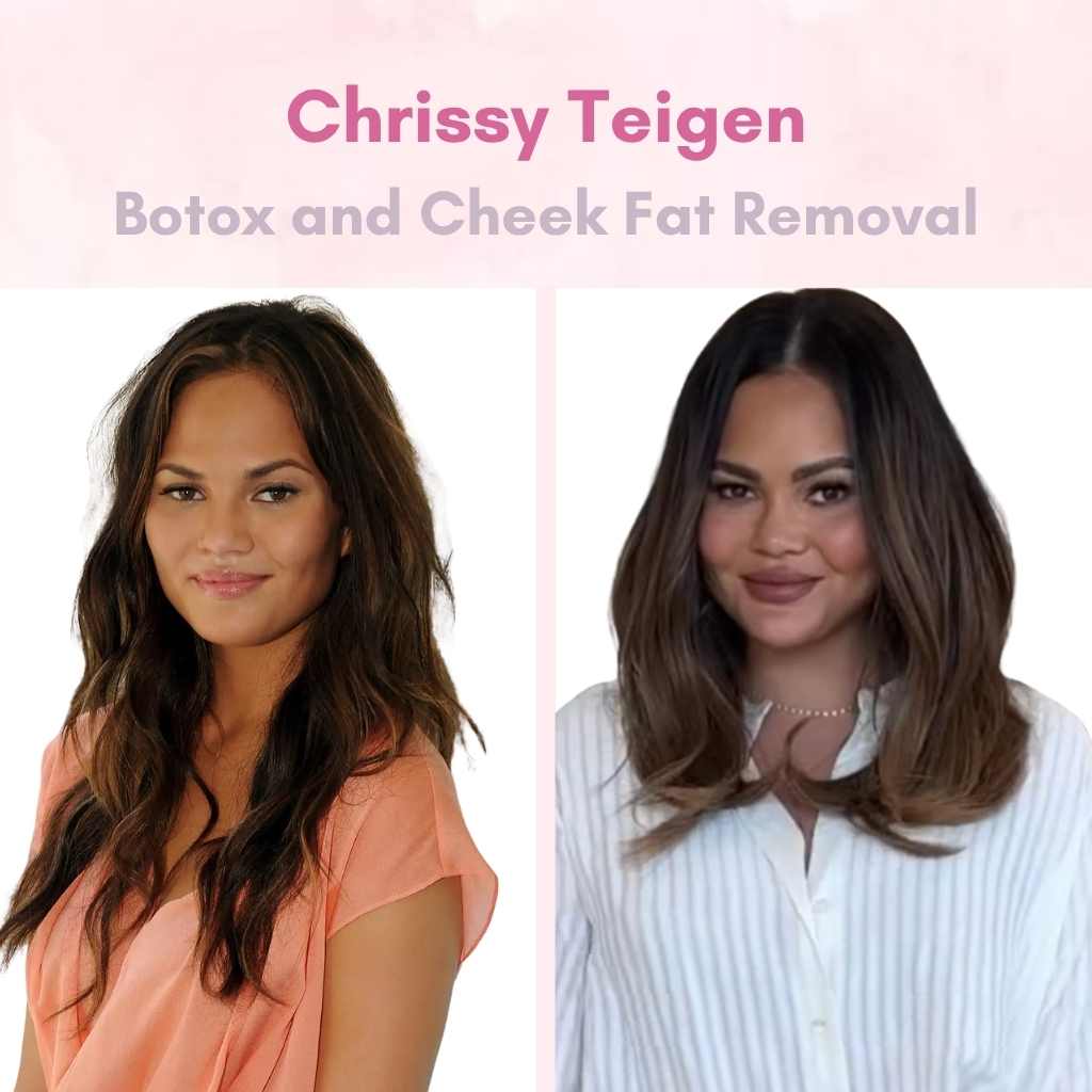 30 Celebrity Botox & Filler Favorites - Vantage Beauty