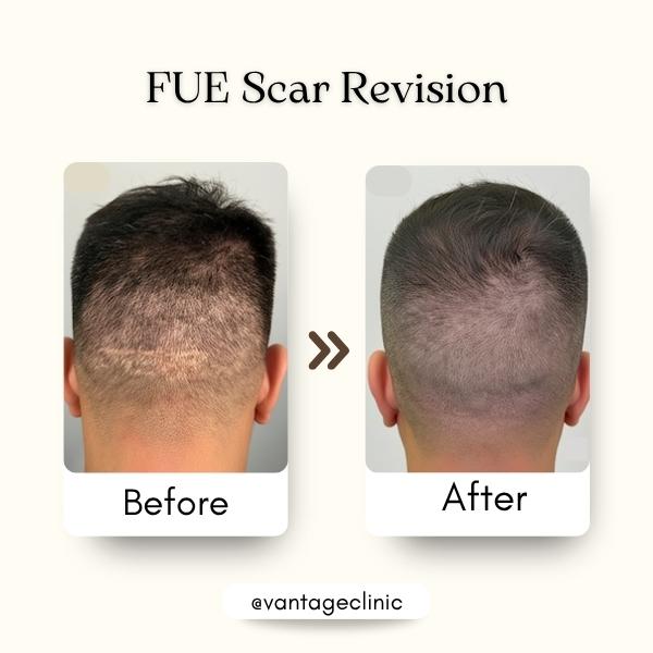 Comprehensive Guide to Donor Scar Revision & Scalp Healing