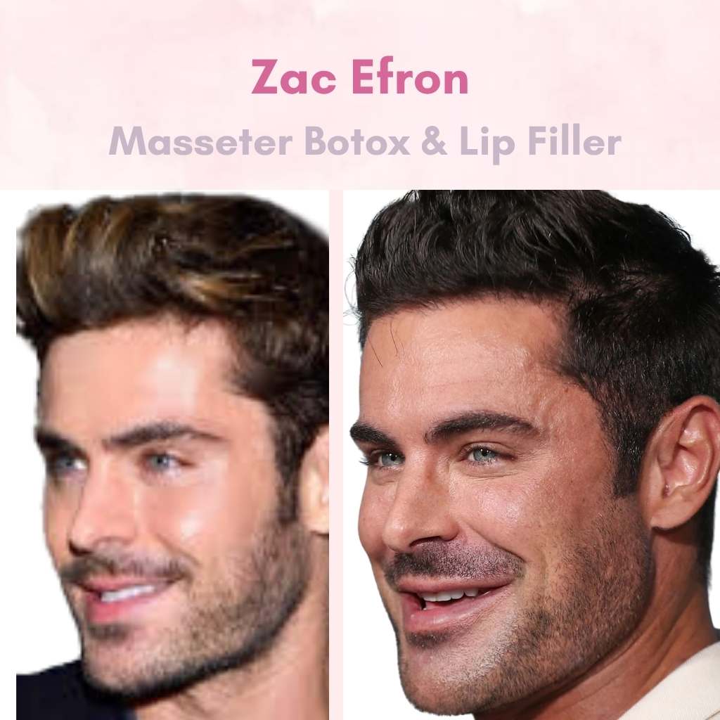 30 Celebrity Botox & Filler Favorites - Vantage Clinic - Cosmetic ...